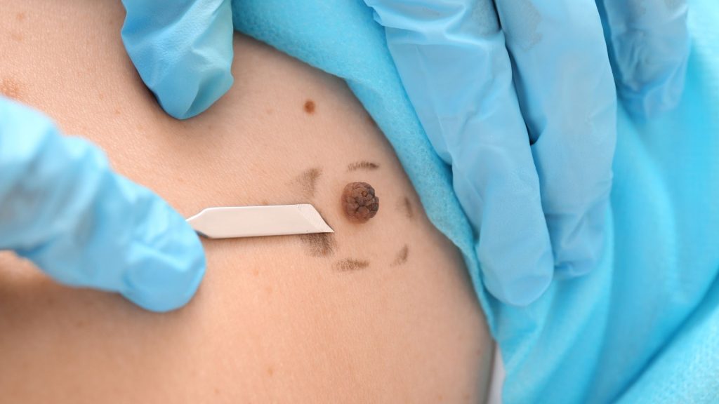 Moles and Warts Removal Treatment Cost in Bangalore - Vasavi Skin Clinic